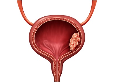 Blaaskanker - Alles over urologie